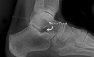 Sinus Tarsi Sendromu – Dora Hospital